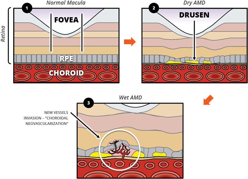 Dry and Wet AMD | Ophthotech Corporation