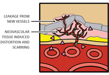 Dry and Wet AMD | Ophthotech Corporation